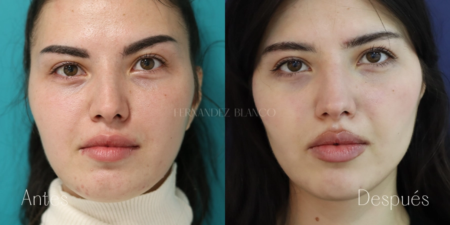 Maria's case : Before and after Bichat Balls : FB