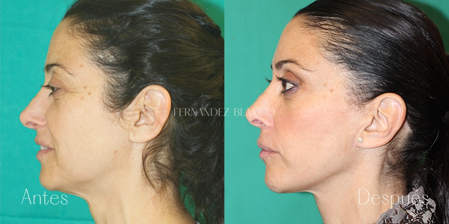 Sarai's Case | Before & After Facelift | FB
