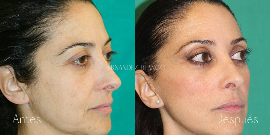 Caso de Sarai | Antes y después Lifting Facial | FB