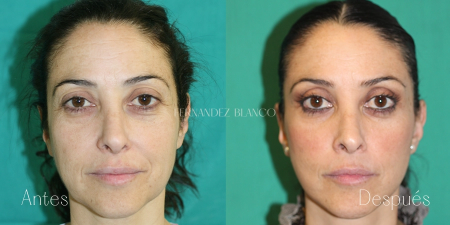 Sarai's Case | Before & After Facelift | FB