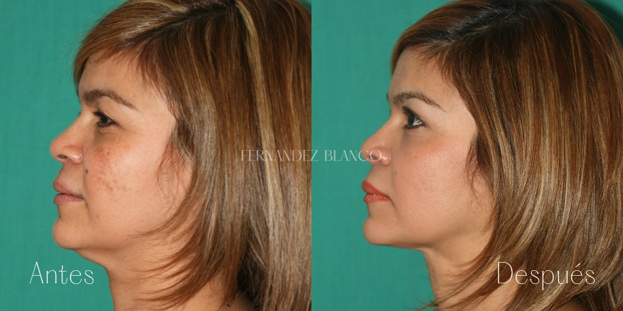 Elena's case : Before and after double chin liposuction : FB