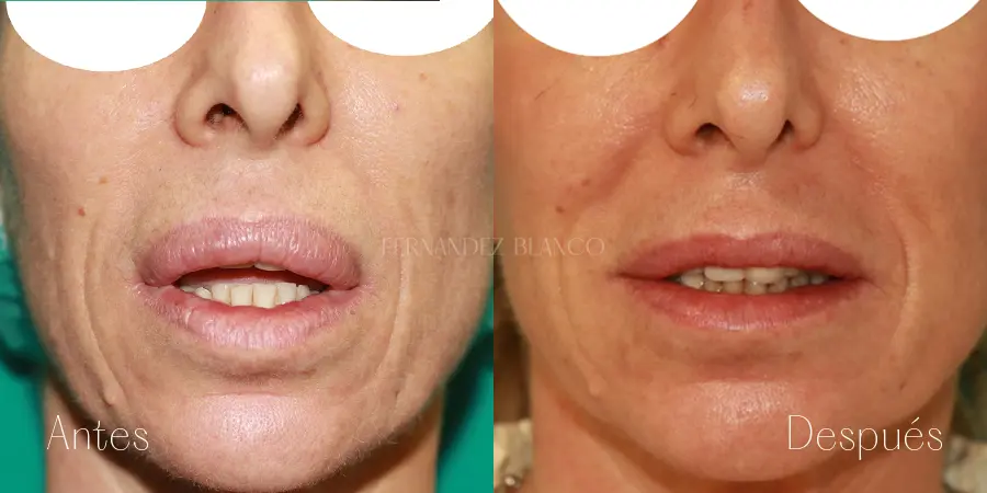 Nora's case | Before and after | Cheiloplasty | FB