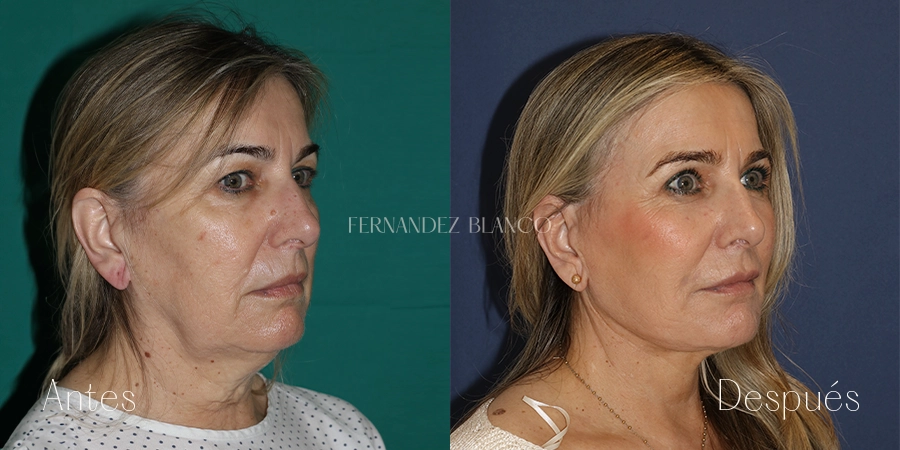 Caso de Elizabeth | Antes y después Lifting Facial | FB