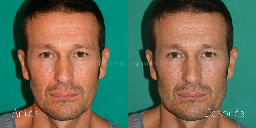 Antonio's case : Before and after Gonion Prosthesis : FB