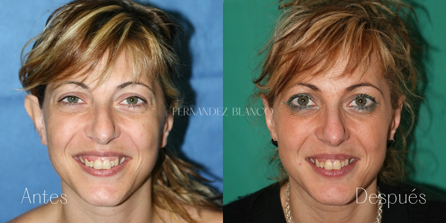 Victoria's case : Before and after Otoplasty : FB