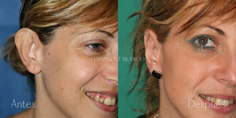 Victoria's case : Before and after Otoplasty : FB