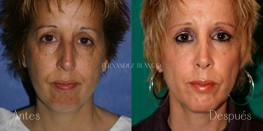Caso de Ana | Antes y después Cirugía de Mentón | FB