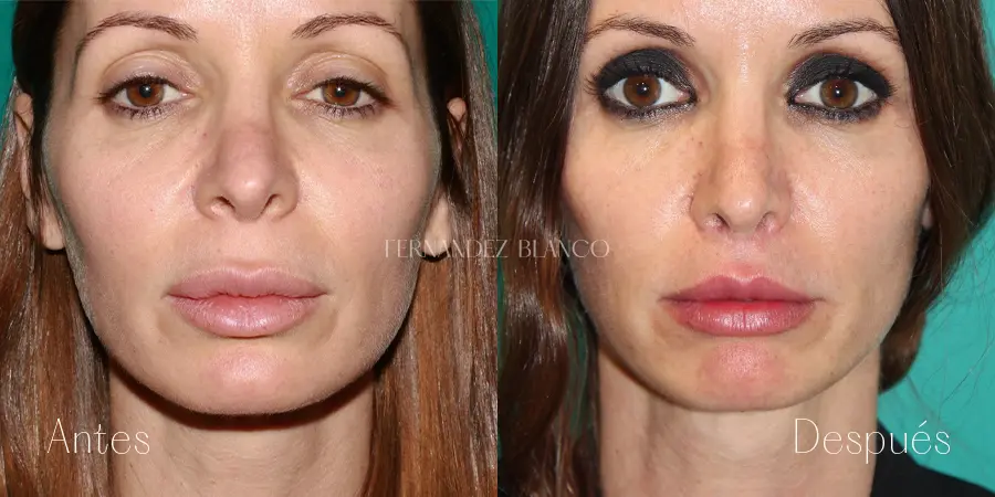Acortamiento De Labios | Cirugía Facial | Clínica FB