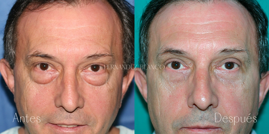 Cirugía de Párpado | Casos Antes y Después | Clínica FB