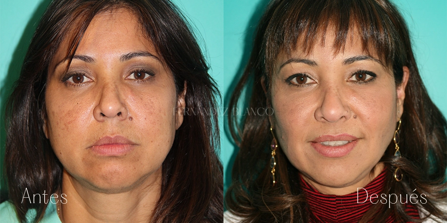 Bolas de Bichat | Casos Antes y Después | Clínica FB