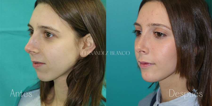 Sofia's Case : Before and after Chin Surgery : FB