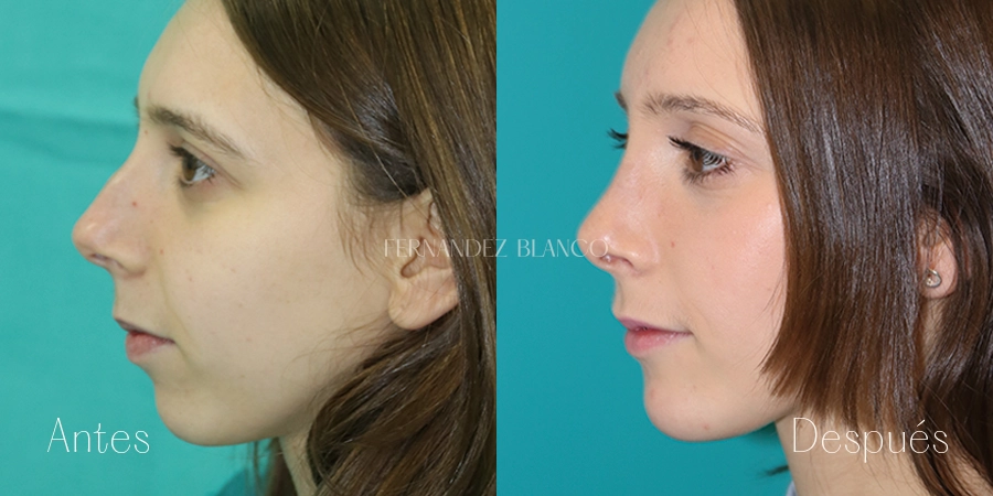 Caso de Paula | Antes y después Cirugía de Mentón | FB