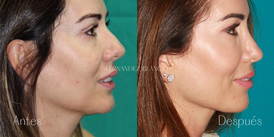 Caso de Laura | Antes y después Bolas de Bichat | FB