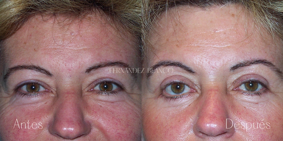 Caso de Abigail | Antes y después Blefaroplastia | FB