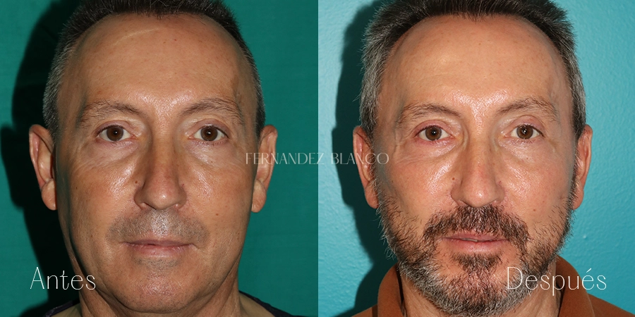 Javier's case | Before and after facelift | FB
