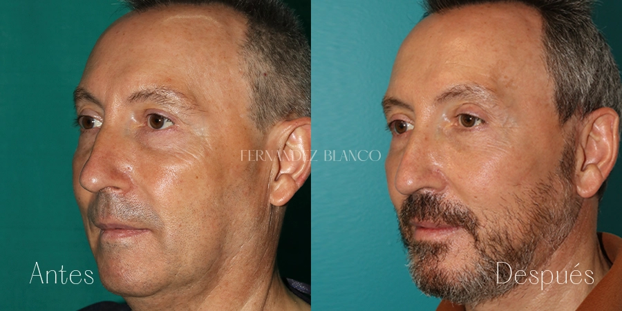 Javier's case | Before and after facelift | FB