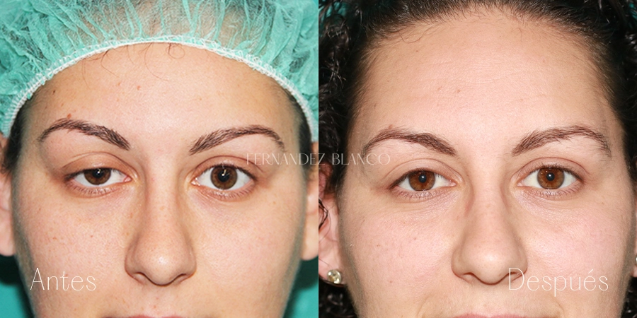 Ariana's case | Before and after Palpebral Ptosis | FB