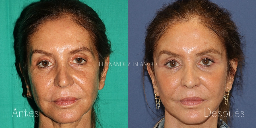 Veronica's Case | Before and After Face Lift | FB