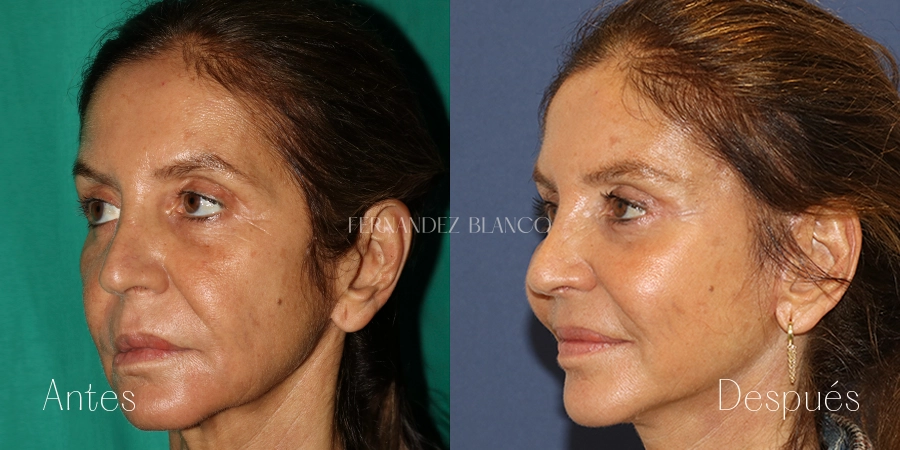 Veronica's Case | Before and After Face Lift | FB